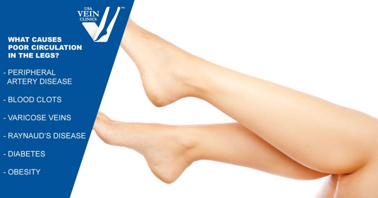 How to Improve Blood Circulation in Legs | USA Vein Clinics