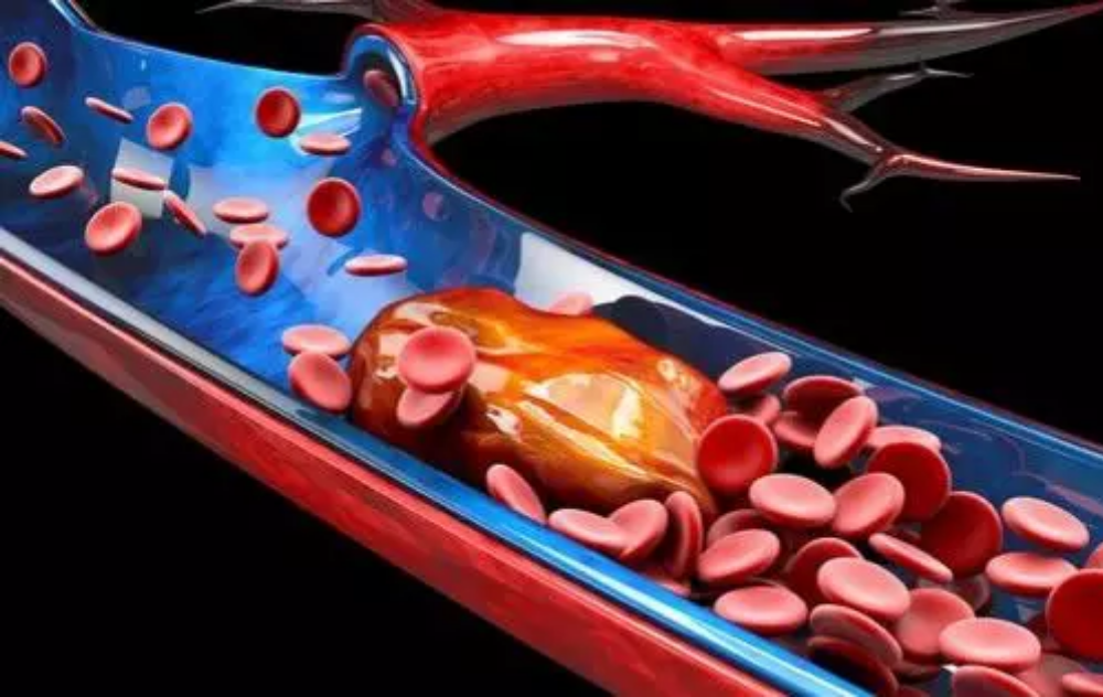 Your Complete Guide To Understanding Blood Clots USA Vein Clinics