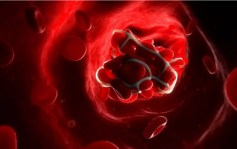 Complete Understanding Of Blood Clots | USA Vein Clinics