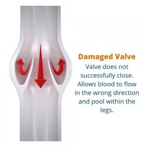 What are Valves in Veins and What is the Function?
