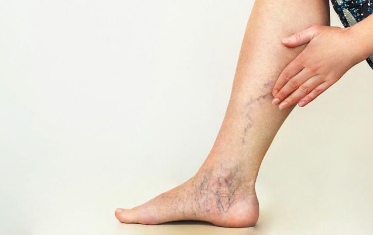 Skin Damage From Vein Disease | USA Vein Clinics