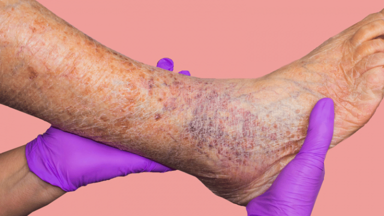 Understanding Skin Discoloration On The Legs: Causes & Treatments
