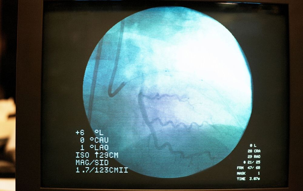 What Is The Saphenous Vein | Blog | USA Vein Clinics