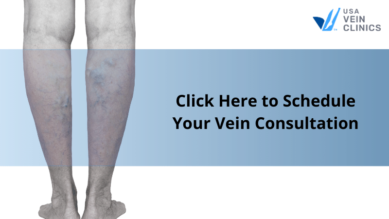 Why Are My Veins So Visible? | USA Vein Clinics
