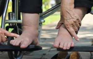 Blood Pooling Causes, Symptoms & Prevention | USA Vein Clinics