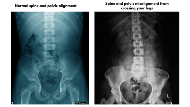 Is Crossing Your Legs Bad For You? Effects On Health & Circulation