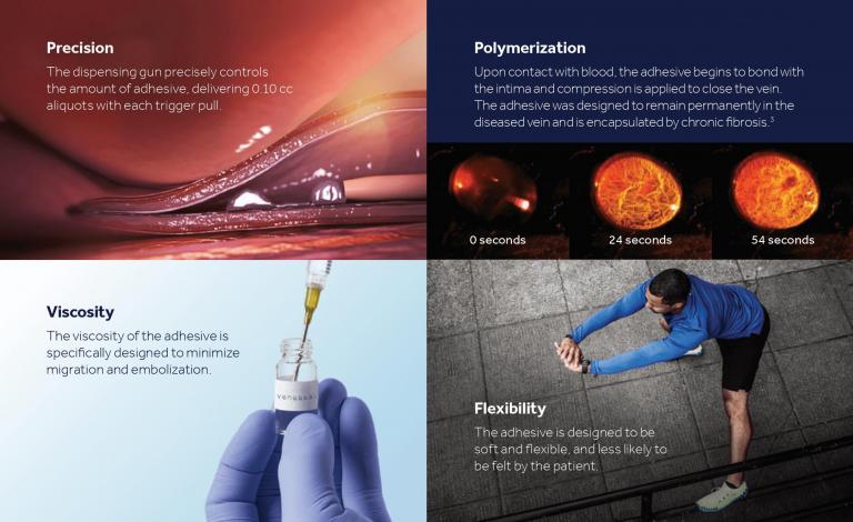 Venaseal Treatment For Varicose Veins | USA Vein Clinics