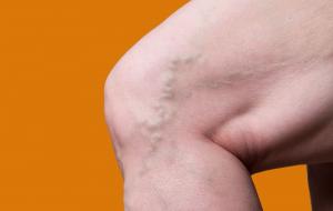Why Are My Veins So Visible? - USA Vein Clinics
