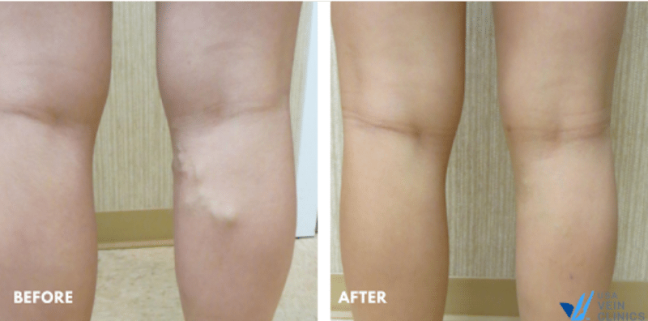 The Reason Why Only One Of Your Legs Is Swollen