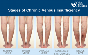 What are the Chronic Venous Insufficiency Stages?