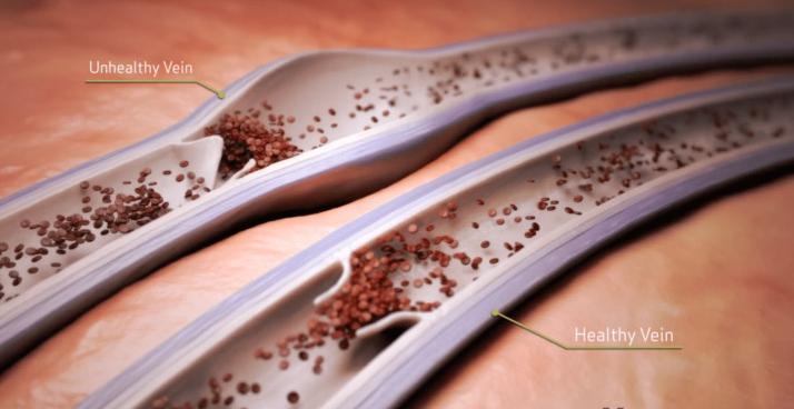 The Importance and Function of Vein Valves | USA Vein Clinics