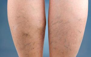 What Blue Vs. Green Veins Mean