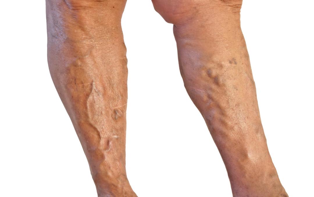 Vascular Disease And Diabetes: How Can They Affect You?