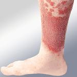 Additional Vein Conditions And Symptoms | USA Vein Clinics