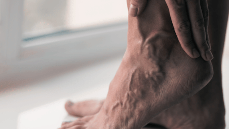 What Is Venous Reflux Disease? - Symptoms & Treatment