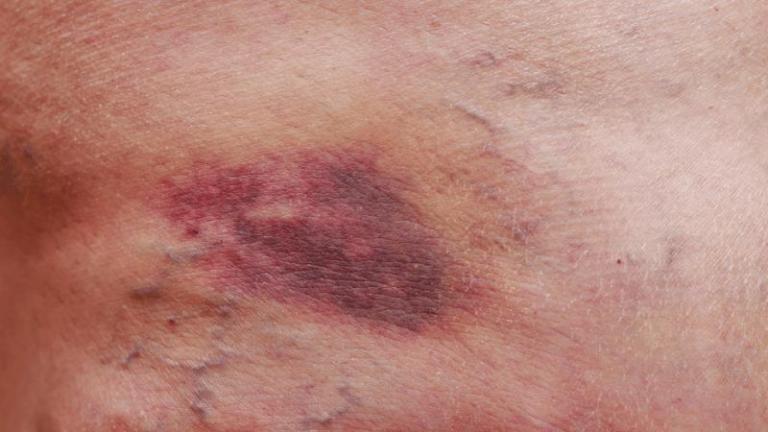 Can Varicose Veins Burst? Causes, Symptoms & What To Do