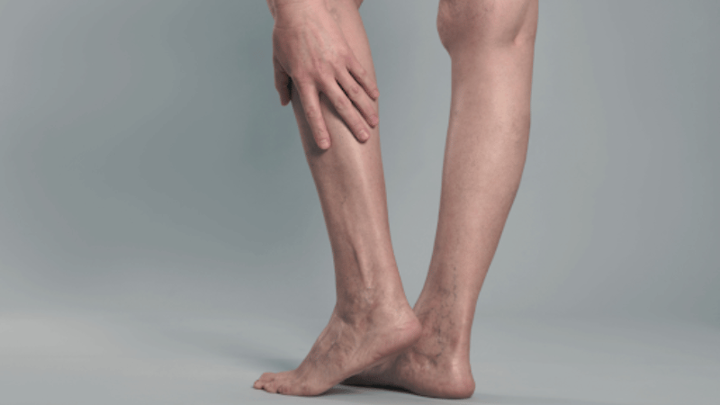 What Is Venous Reflux Disease? - Symptoms & Treatment