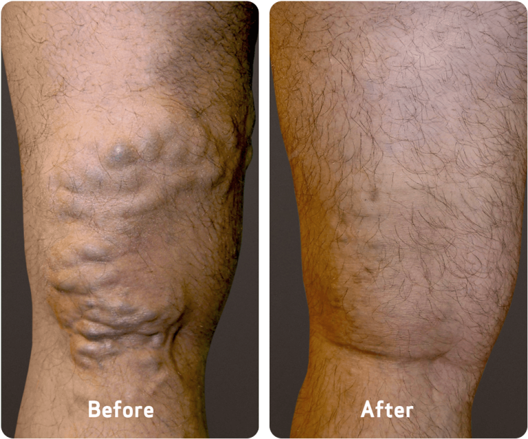 Minimally Invasive Vein Treatments | USA Vein Clinics