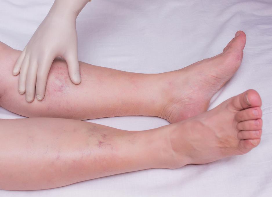 Are Varicose Veins A Warning Sign Of Potentially Deadly Clots?