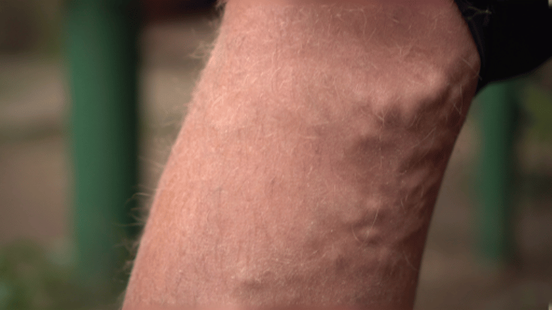 Venous Ultrasound: What An Ultrasound For Leg Veins Can Reveal