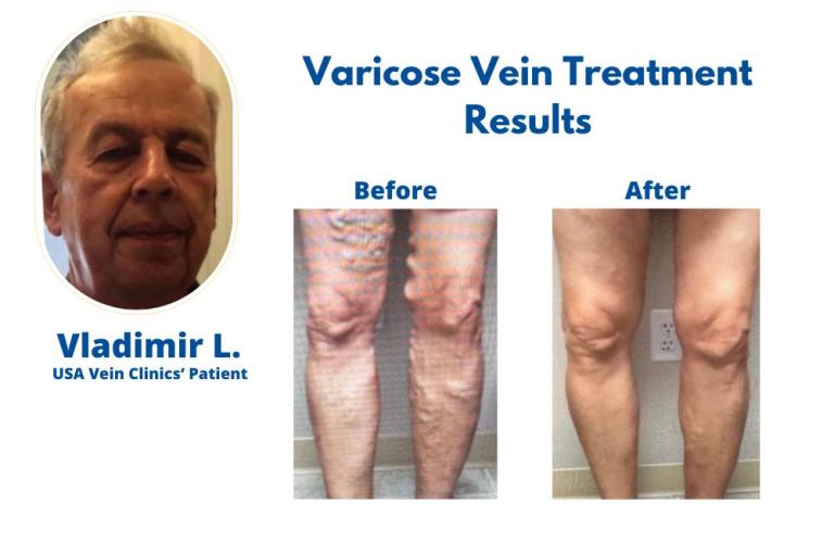 Why Thanking A Vein Doctor Matters | USA Vein Clinics