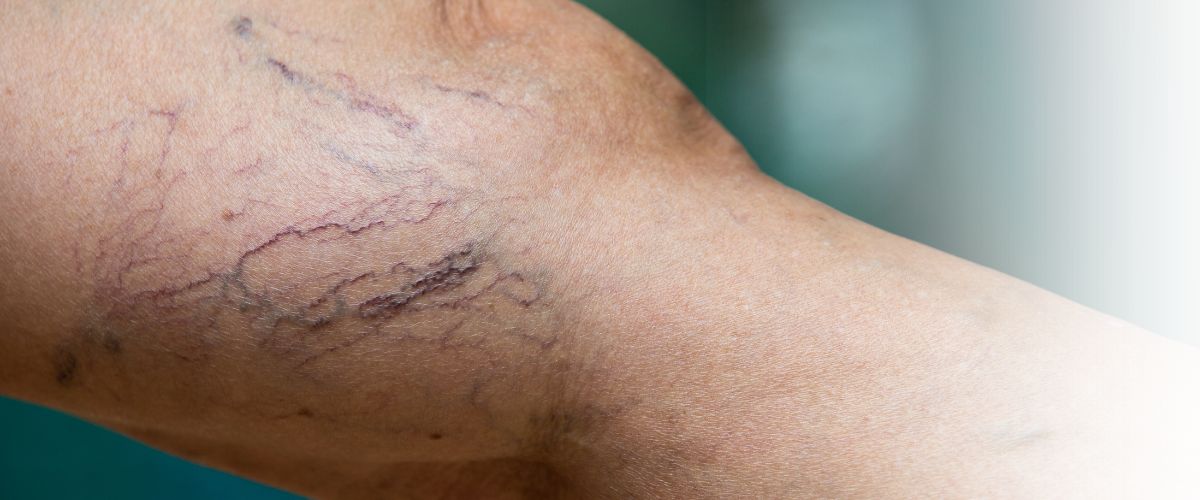 Spider Veins: Symptoms & Signs | USA Vein Clinics