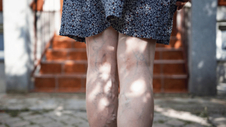 Why Are My Veins Blue? | USA Vein Centers