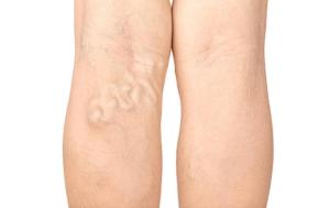 Deep Vein Thrombosis: Early Warning Signs & Symptoms