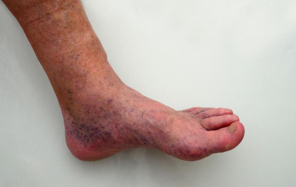 Understanding Skin Discoloration On The Legs: Causes & Treatments