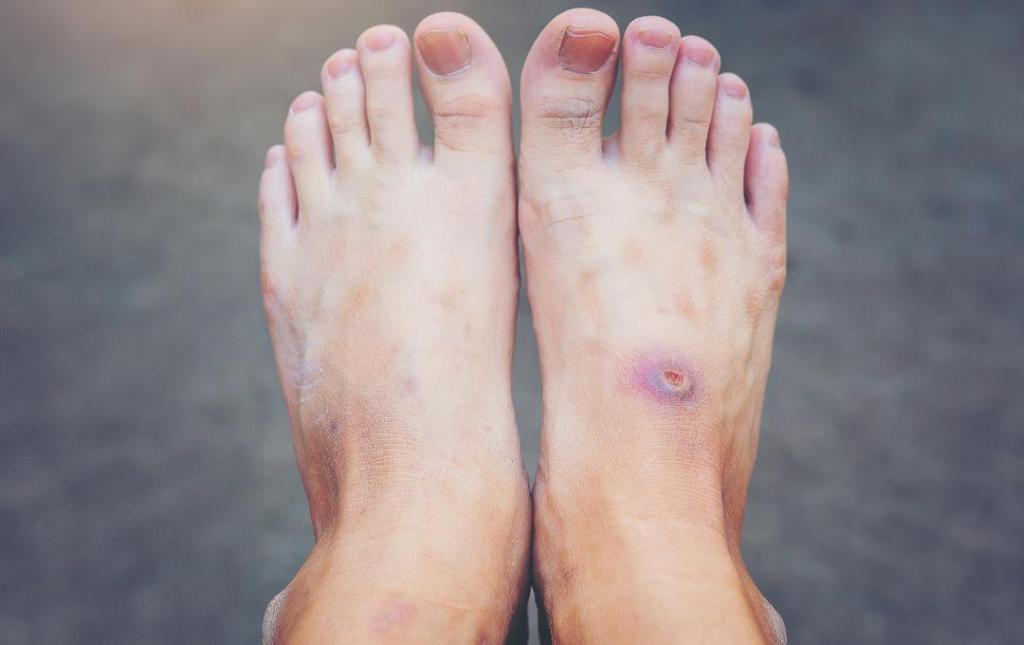 What Do Leg Ulcers Look Like? | USA Vein Clinics