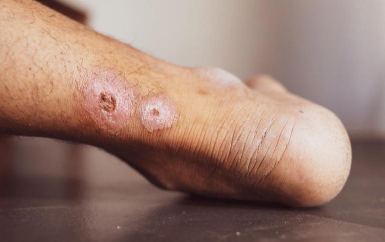 Early Signs Of Venous Leg Ulcers