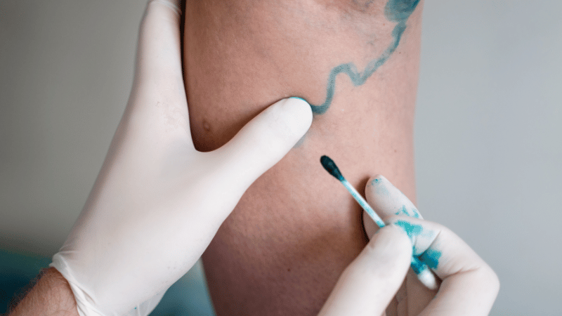 Signs & Symptoms Of Early Chronic Venous Insufficiency