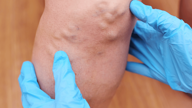 How And Why Do Veins Collapse?