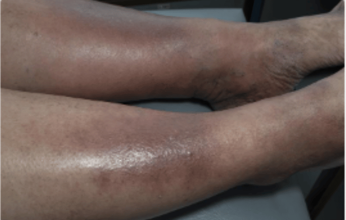 How Does Varicose Eczema Develop? Symptoms & Treatment