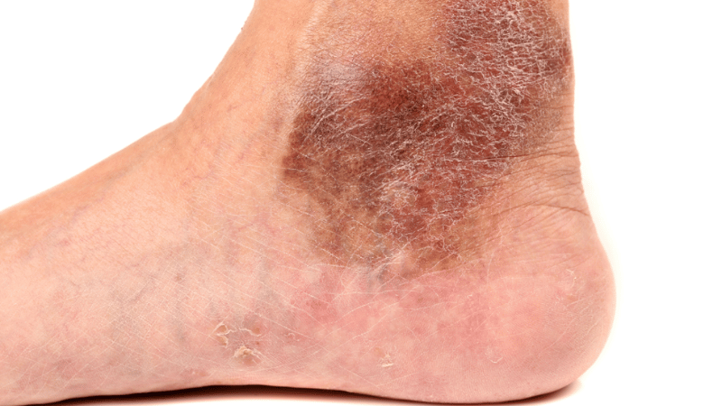 How Does Varicose Eczema Develop? Symptoms & Treatment