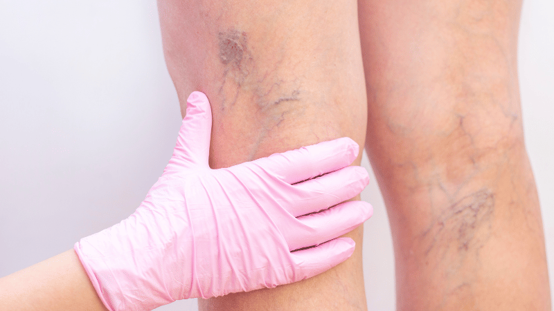 Are Varicose Veins A Sign Of Phlebitis?