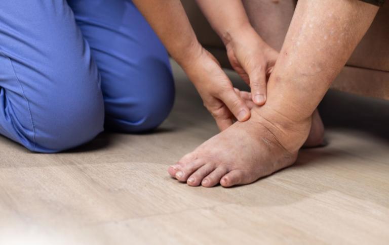 Is Edema In Legs Dangerous? Understanding Causes, Risks