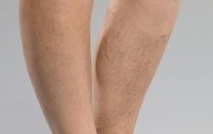 Understanding Brown Skin Discoloration On The Lower Legs | USA Vein Clinics