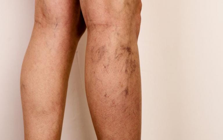 Normal Veins Vs Reticular Veins: Key Differences