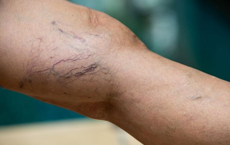 Normal Veins Vs Reticular Veins: Key Differences