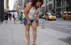 What Does An Unhealthy Vein Look Like? | USA Vein Clinics